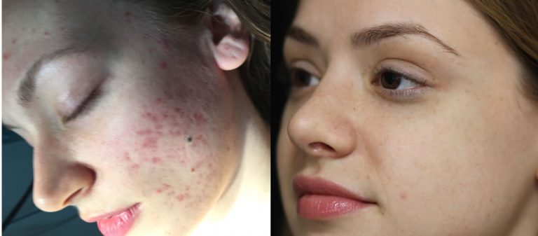 Is Vampire Facial Good for Acne Scars? 5 Real Facts